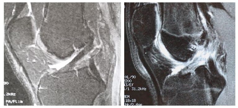 Ligamentoplastie du ligament croisé | Clinique de la hanche et du genou